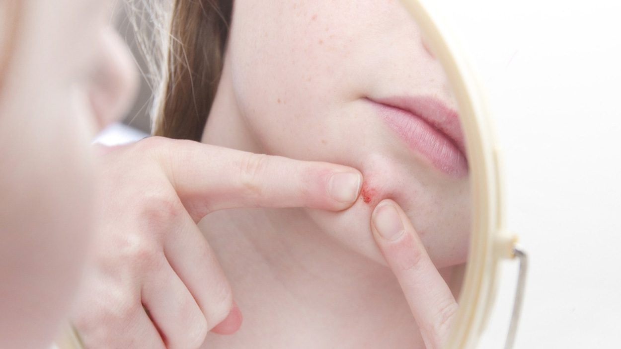 Pickelnarben vermeiden oder verringern - ALHYDRAN DE